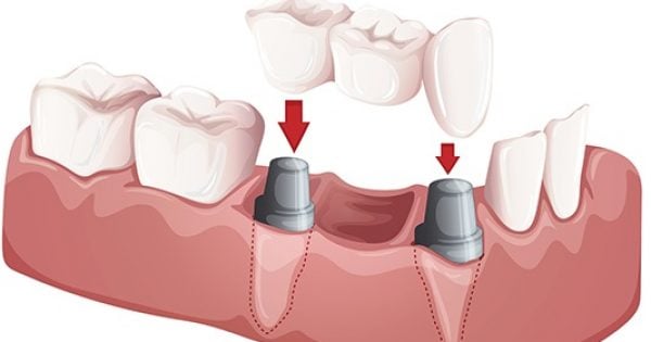 What is a Bonded Dental Bridge? | Advanced Periodontics NYC / NJ