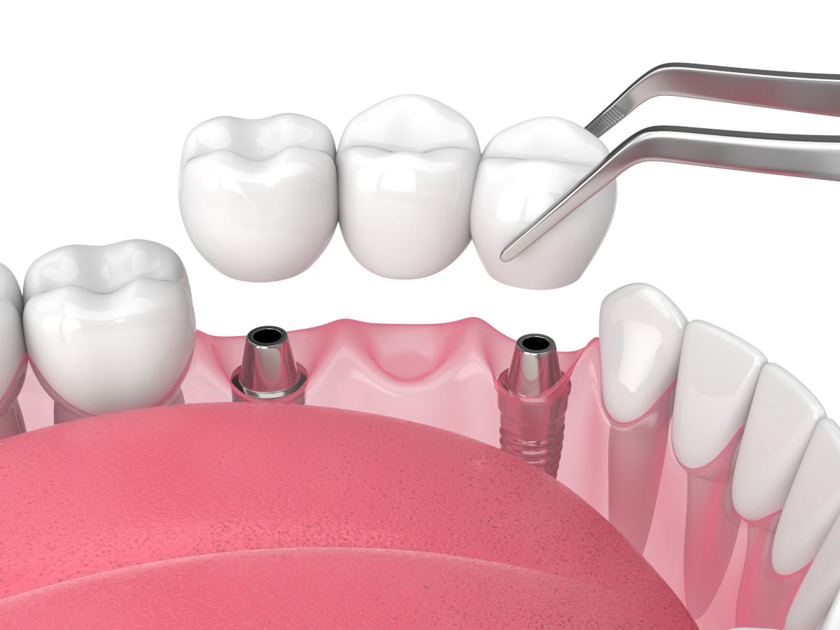 Dental Implant-Supported Fixed Bridge: A Permanent Solution for Missing ...